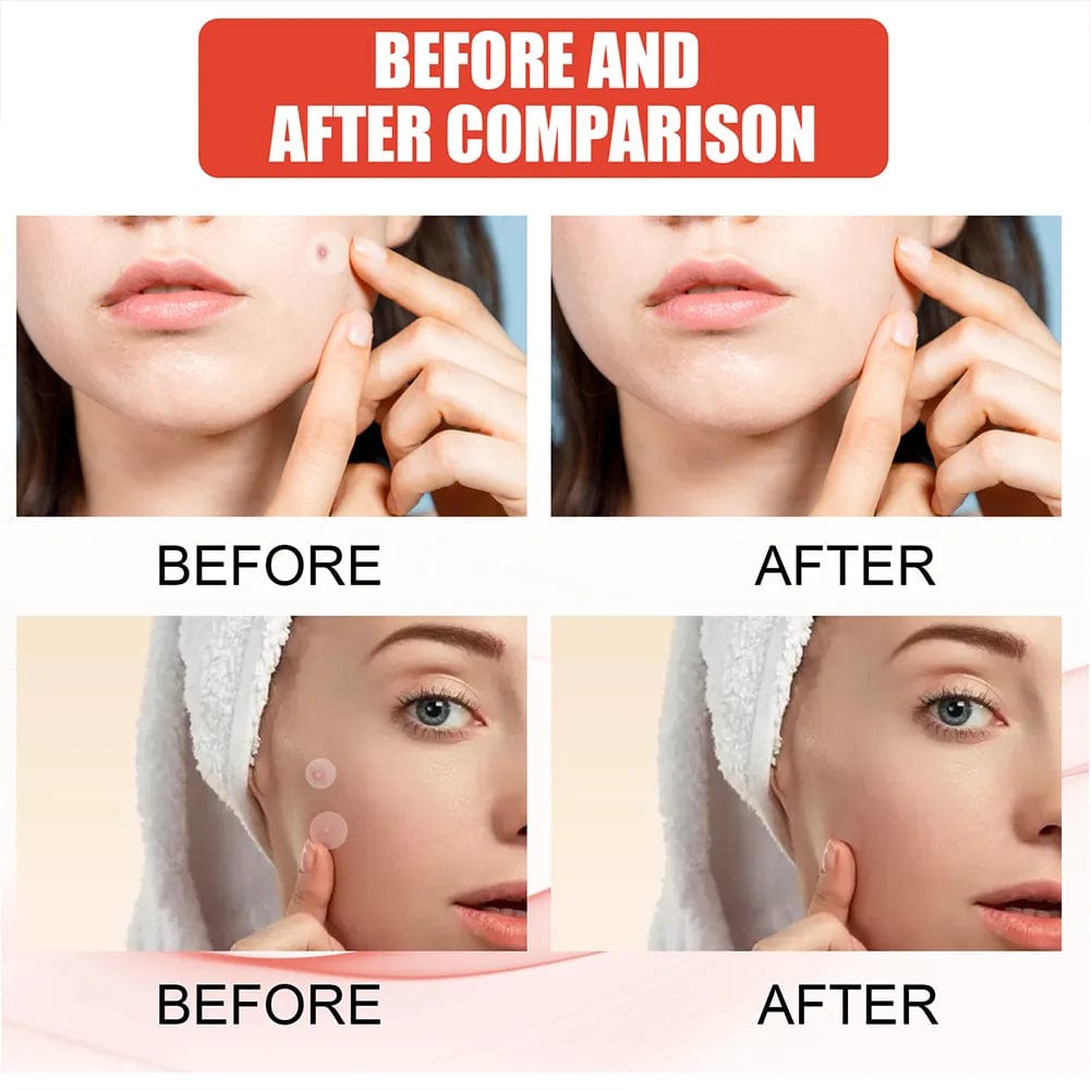 Acne Cover Patches, Hydrocolloid Acne Pimple Patches, Day and Night Zi ...
